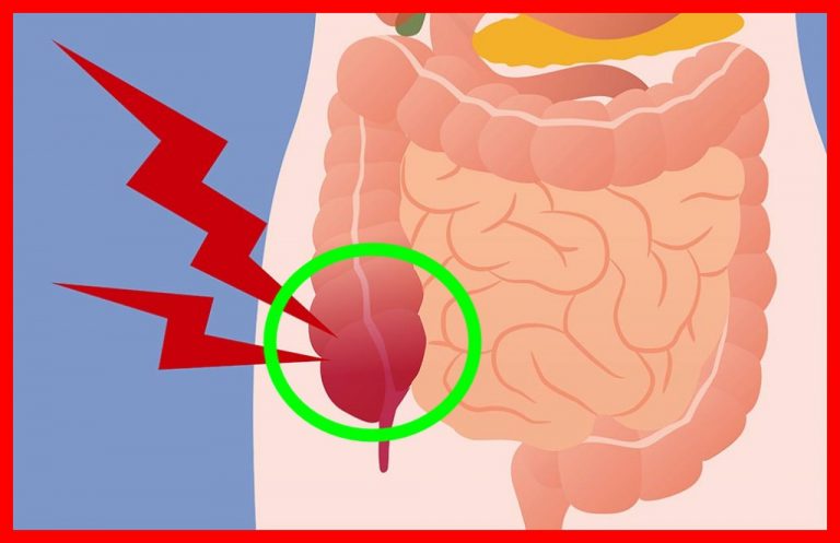 APENDICITE - O que é, Sintomas, Causas e Tratamentos! | Cura Natural