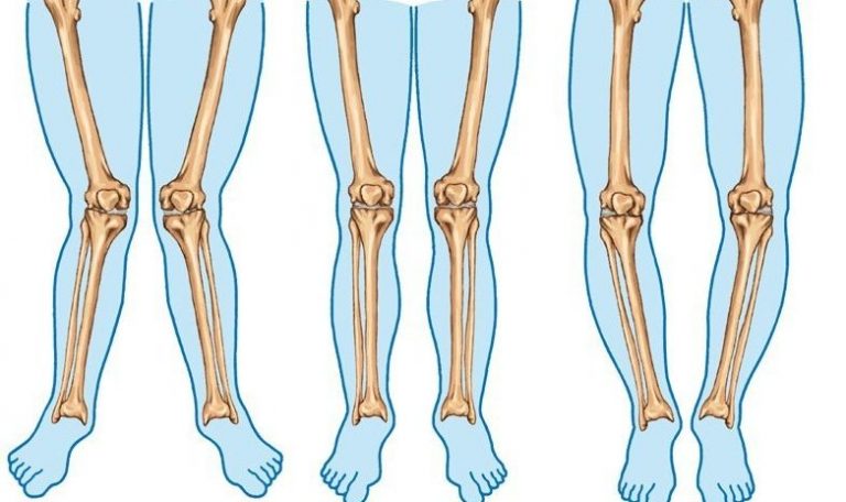 Raquitismo - O que é, Causas, Sintomas e Tratamentos | Cura Natural