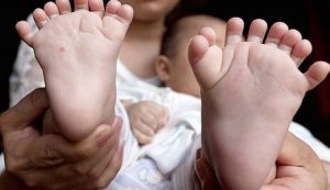 Polidactilia - O que é, Causas, Sintomas e Tratamentos | Cura Natural